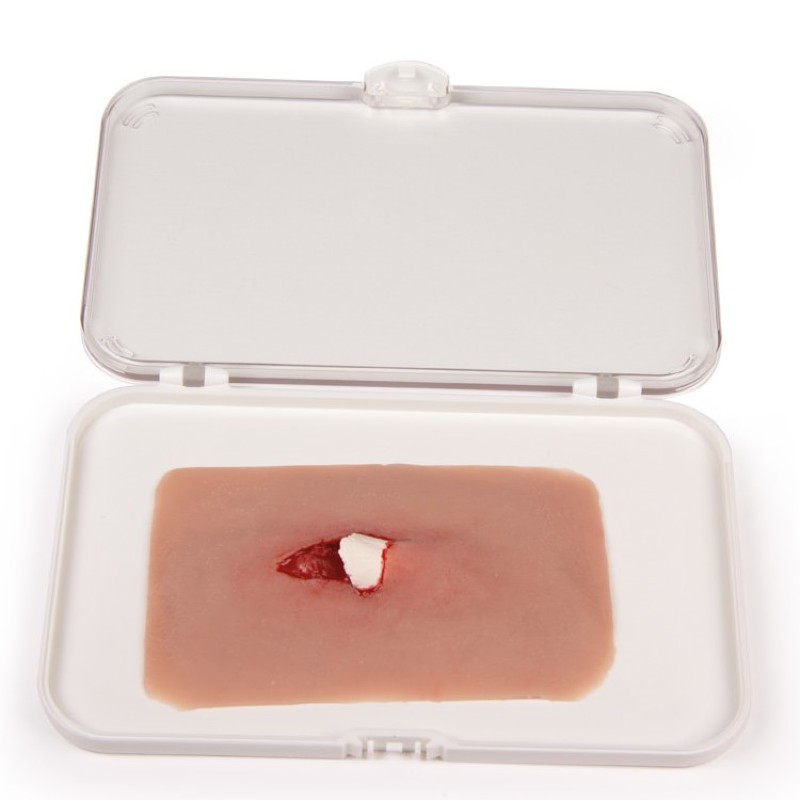 Erler-Zimmer Moulage Open Fracture - MedicalSupplies.co.uk